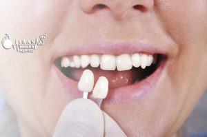 Dental Crowns In Iran At Affordable Cost - Iran Health Agency