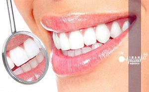 Dental Crowns In Iran At Affordable Cost - Iran Health Agency