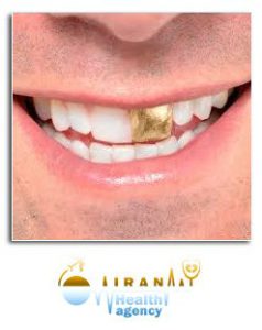 Dental Crowns In Iran At Affordable Cost - Iran Health Agency