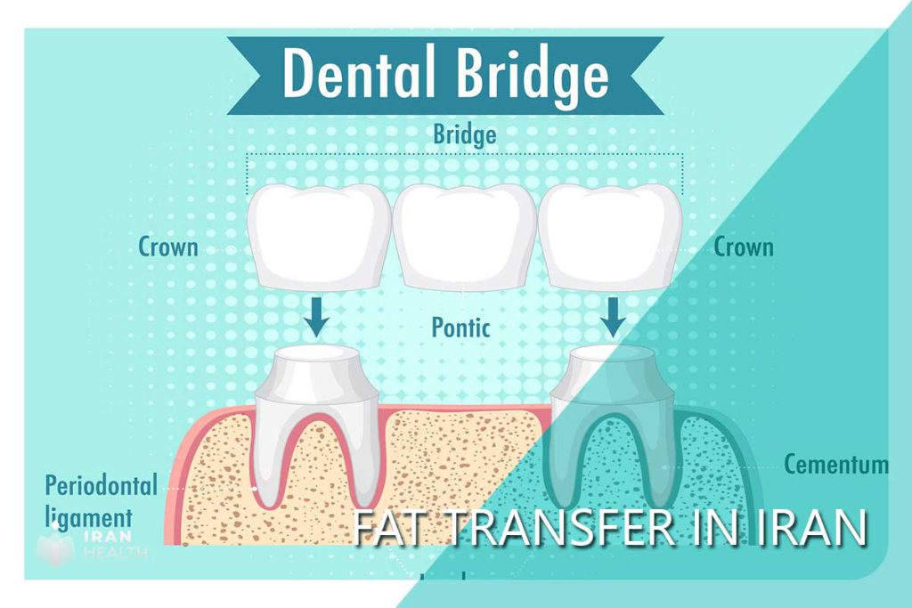 Dental Crowns In Iran At Affordable Cost - Iran Health Agency
