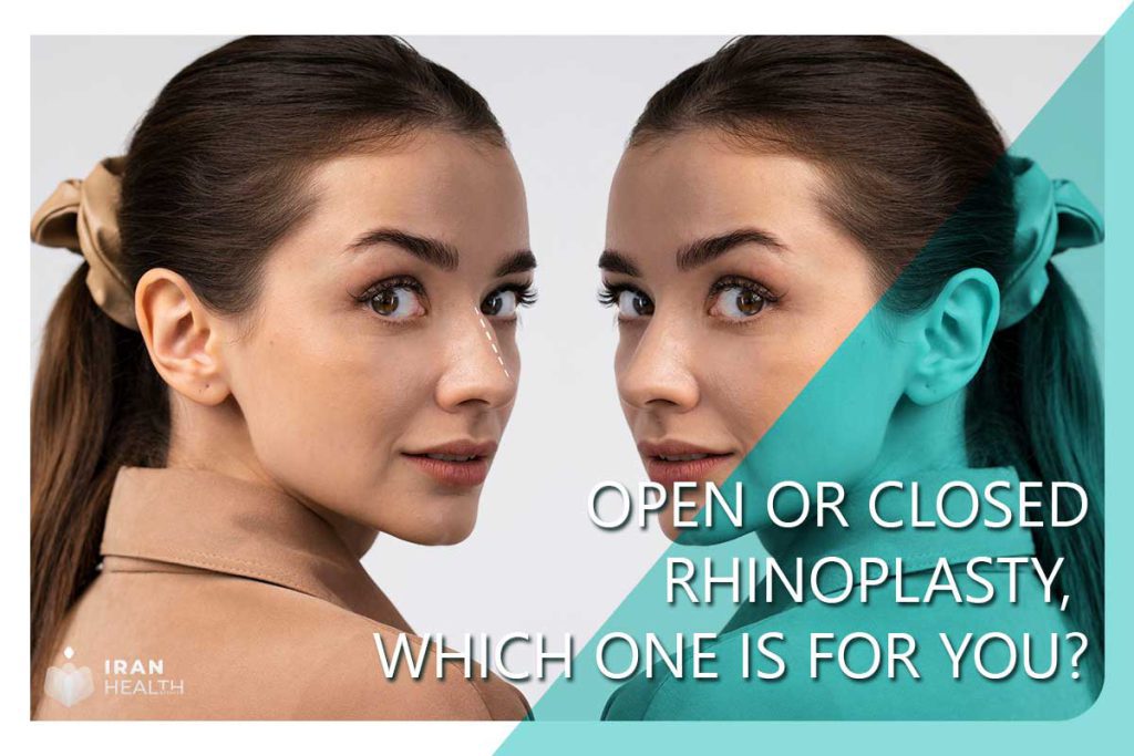 Open Or Closed Rhinoplasty, Which One Is For You - Iran Health Agency
