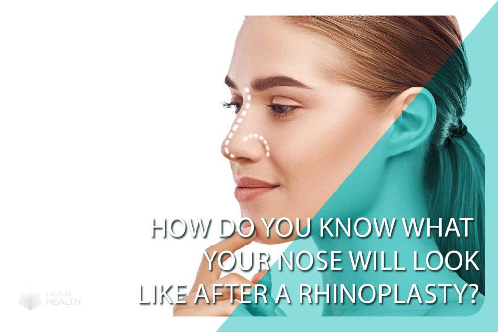 How Do You Know What Your Nose Will Look Like After A Rhinoplasty?