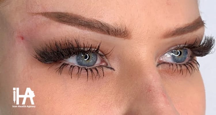 What Is A Cat's Eye Operation, Or Canthoplasty?