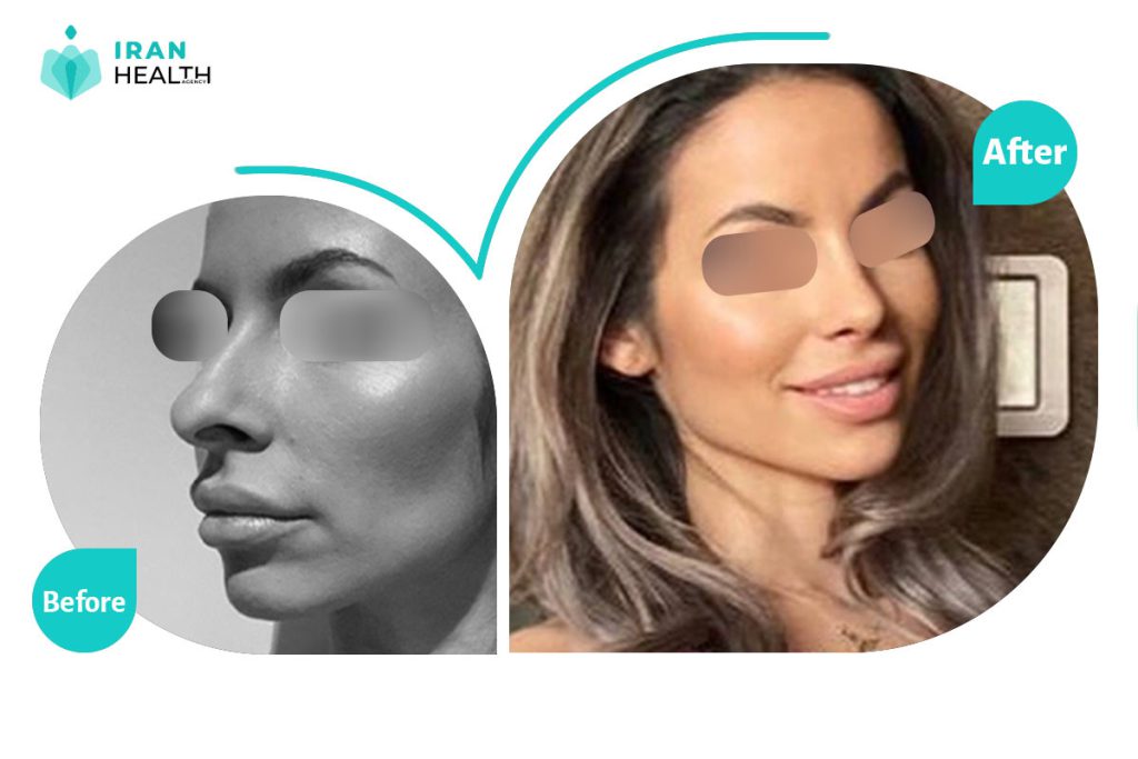 Rhinoplasty In Iran | The Best Nose Job Cost And See Results