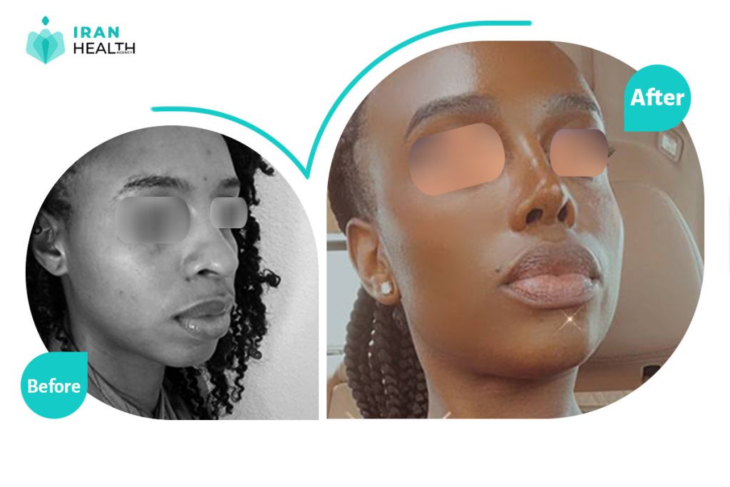 Rhinoplasty In Iran | The Best Nose Job Cost And See Results