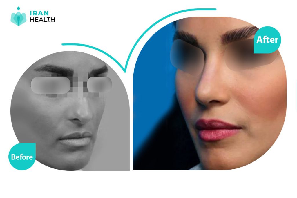 Rhinoplasty In Iran | The Best Nose Job Cost And See Results