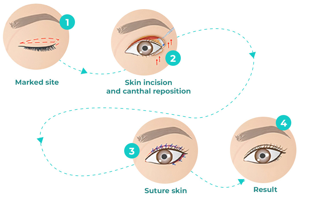 Cat Eye Surgery In Iran | Affordable Cost, Best Surgeons And Hospitals