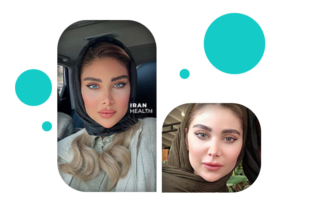 Cat Eye Surgery In Iran | Affordable Cost, Best Surgeons And Hospitals