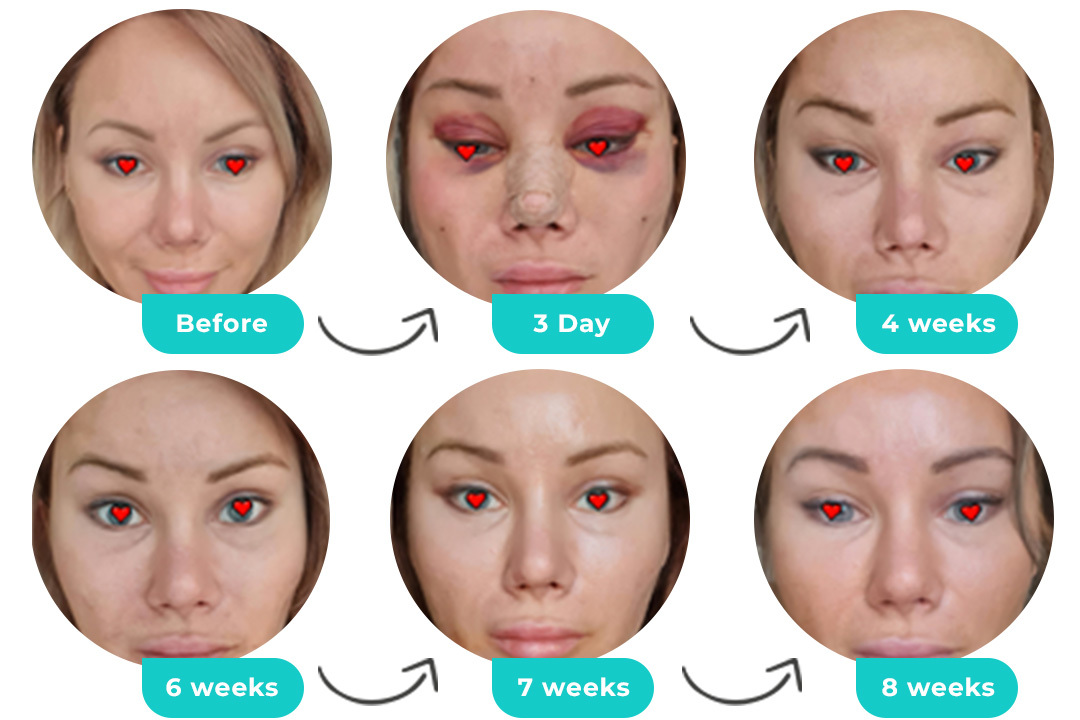 Cat Eye Surgery In Iran | Affordable Cost, Best Surgeons And Hospitals