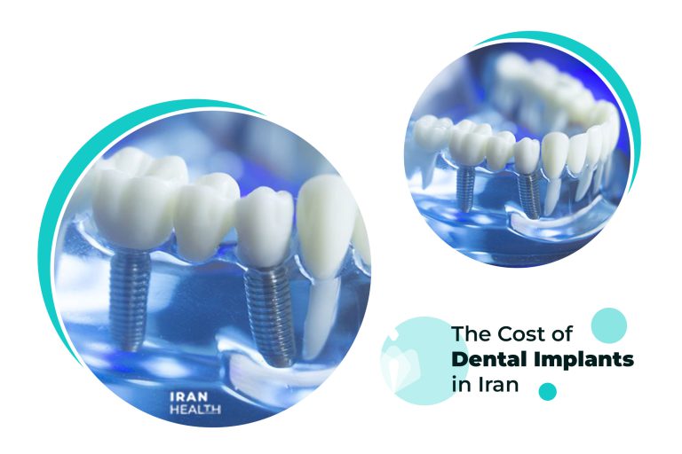 Dental Implant In Iran |cost Of Dental Implant In Iran - Iran Health Agency