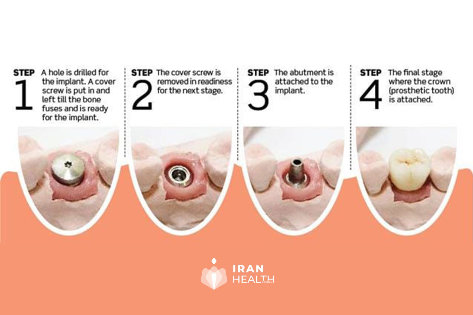 Dental Implant In Iran | Best Dentists And Lowest Cost