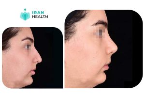 Rhinoplasty In Iran | The Best Nose Job Cost And See Results