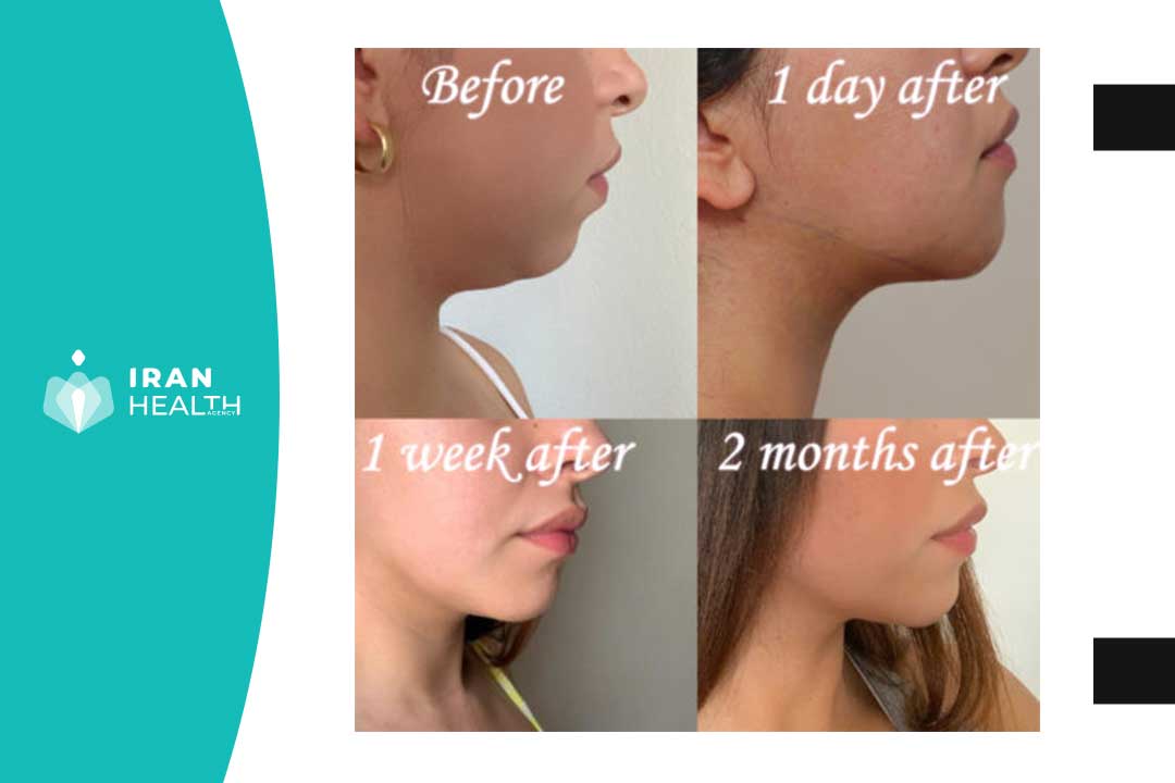 Double Chin Surgery In Iran | Double Chin Removal Best Cost And Surgeons