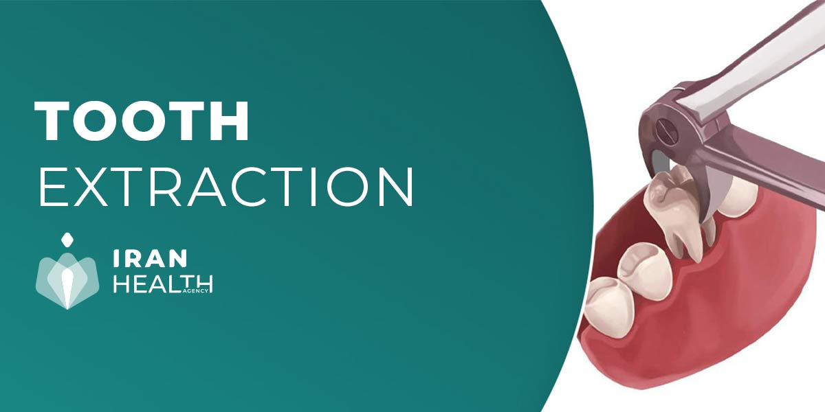 Tooth Extraction In Iran | Medical Tourism In Iran