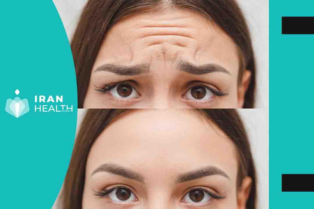 Botox In Iran: Transform Your Look | Medical Tourism In Iran