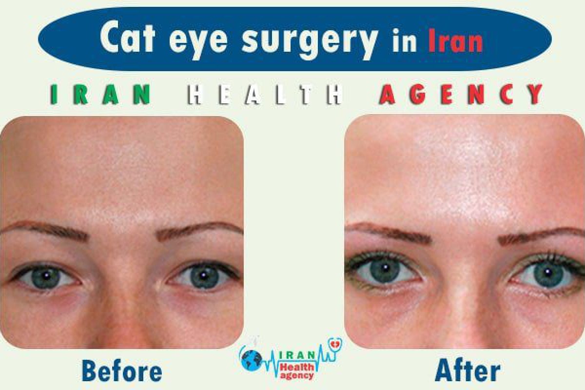 Do I Need Nose Job? | Iran Health Agency